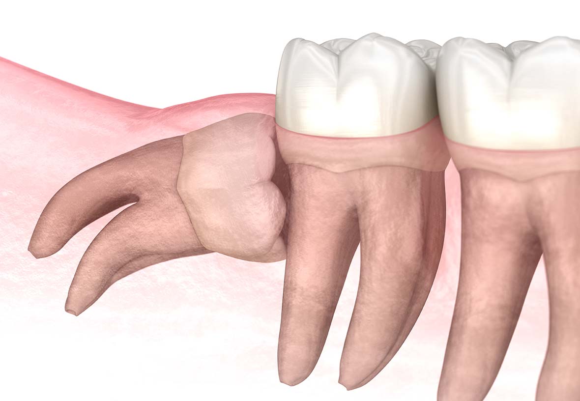 Wisdom Teeth Removal | Tacoma Dental Centre